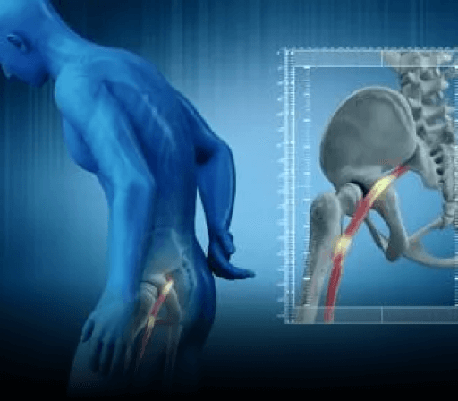 Lumbar Radiculopathy | Royal Spine Surgery